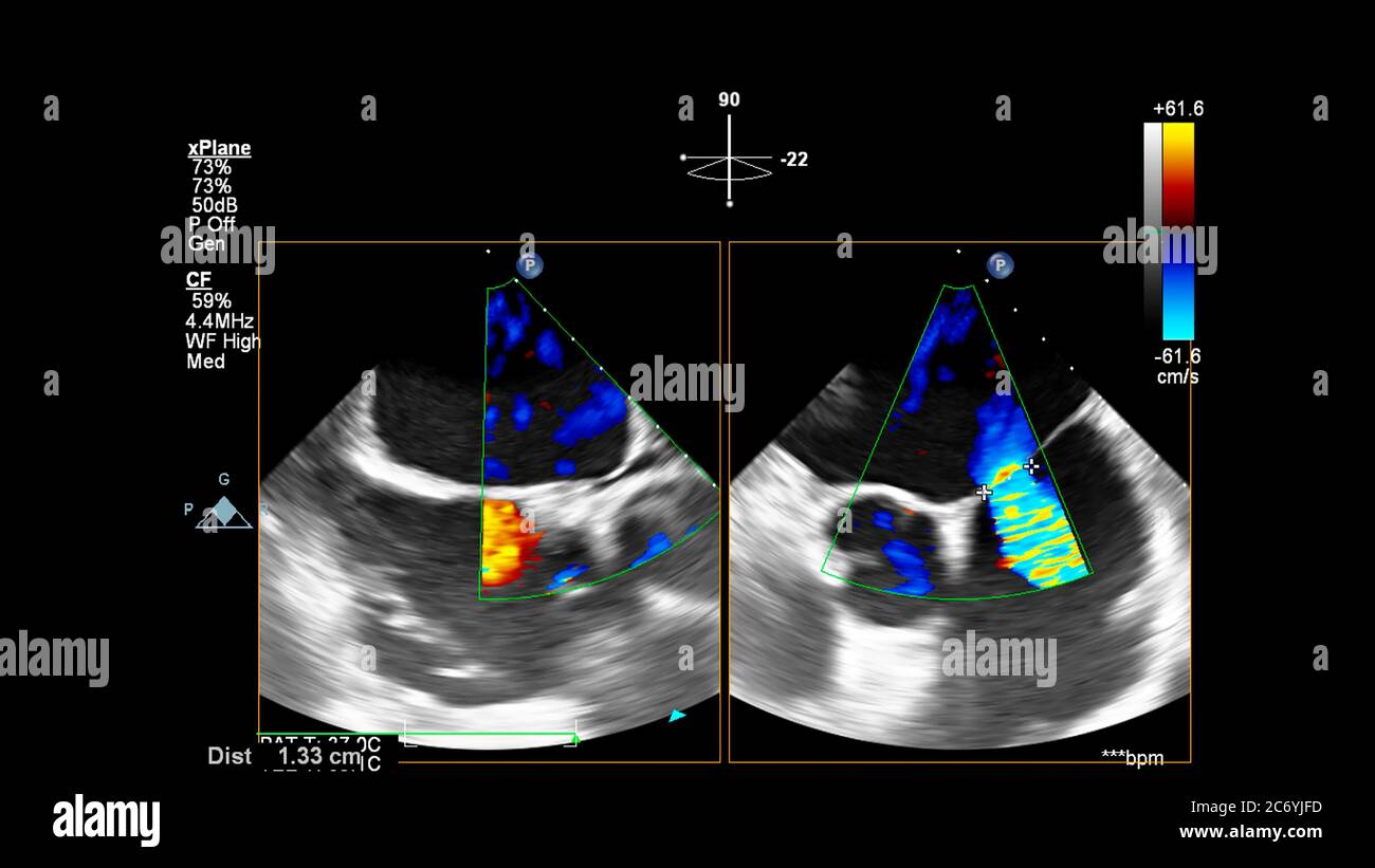 Transesophageal echocardiogram hi-res stock photography and images - Alamy