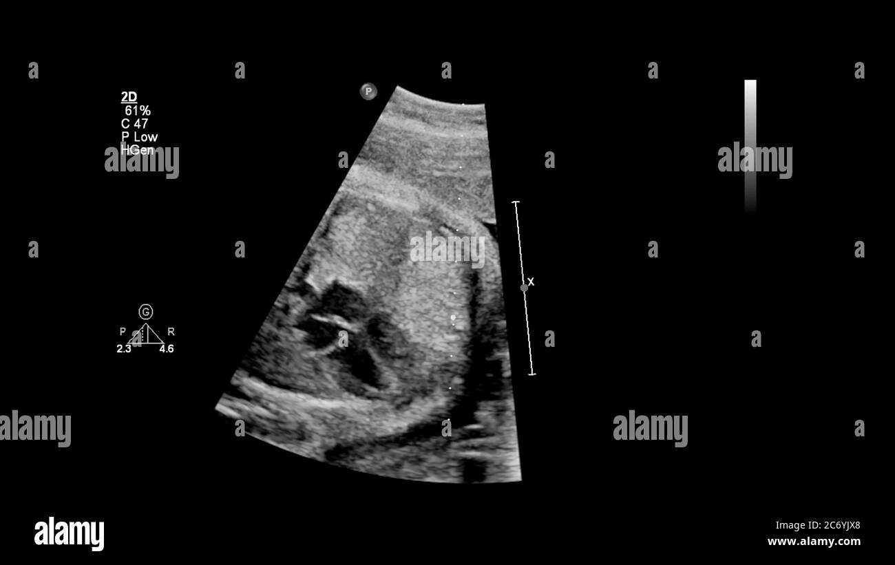 Ultrasound screen with fetal echocardiography Stock Photo - Alamy