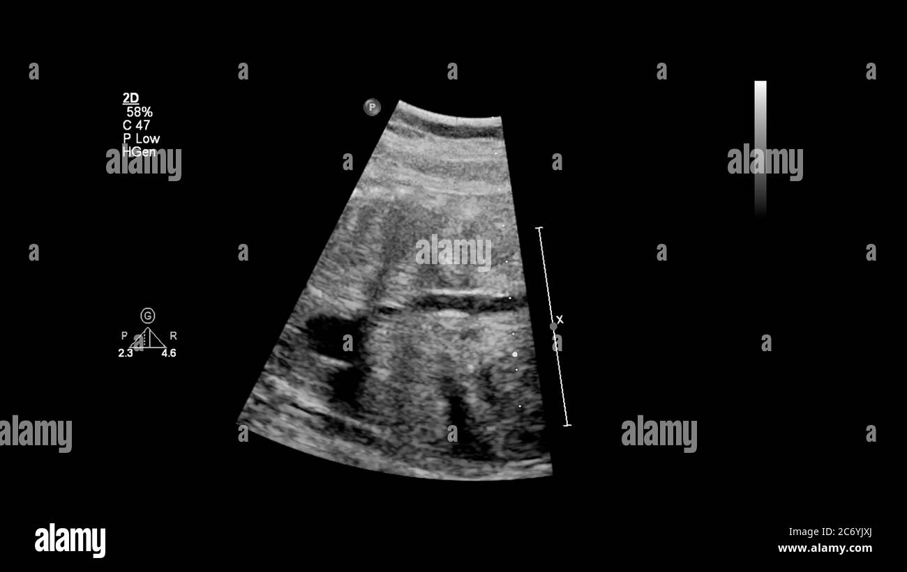 Ultrasound screen with fetal echocardiography Stock Photo - Alamy