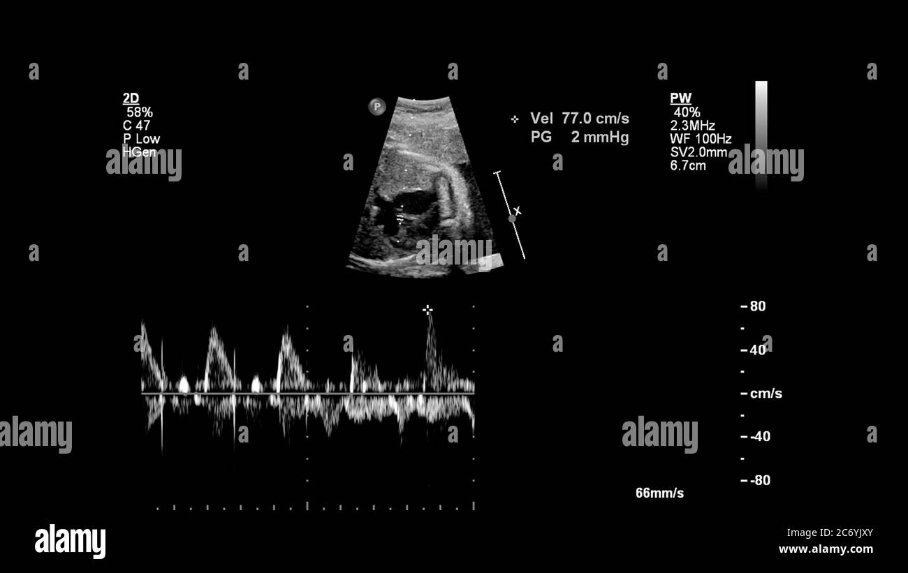 Placenta frame hi-res stock photography and images - Alamy