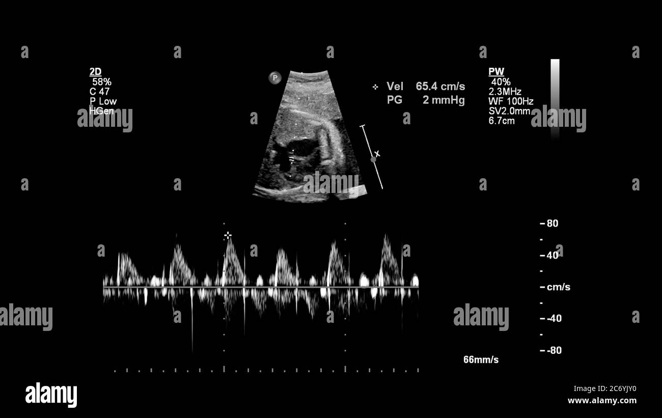 Ultrasound screen with fetal echocardiography Stock Photo - Alamy