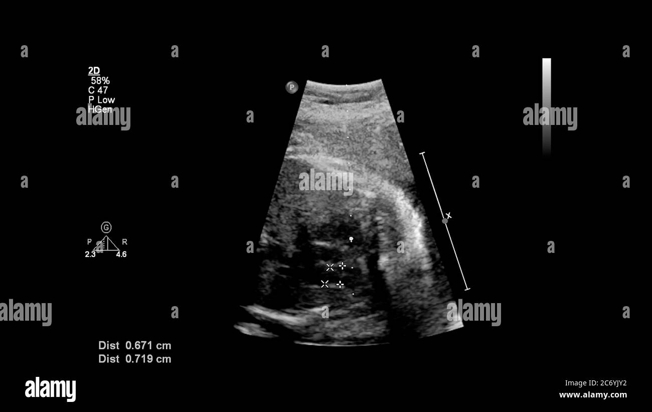 Ultrasound screen with fetal echocardiography Stock Photo - Alamy