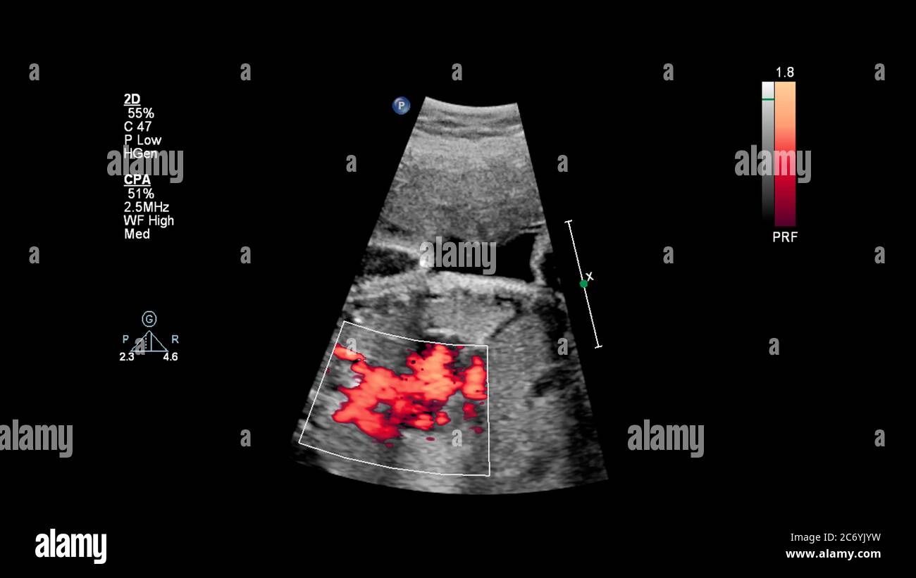 Ultrasound screen with fetal echocardiography Stock Photo - Alamy