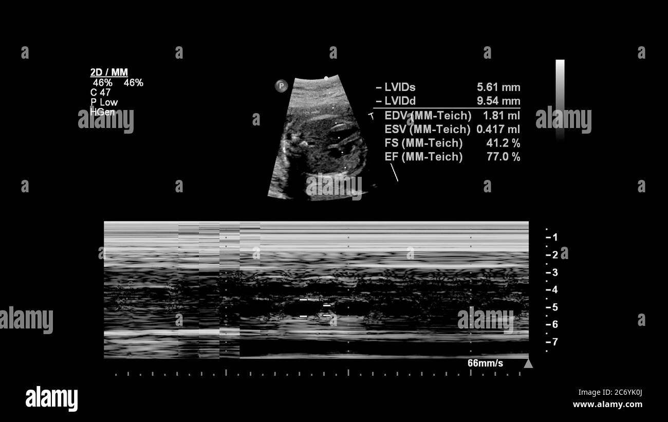 Ultrasound screen with fetal echocardiography Stock Photo - Alamy