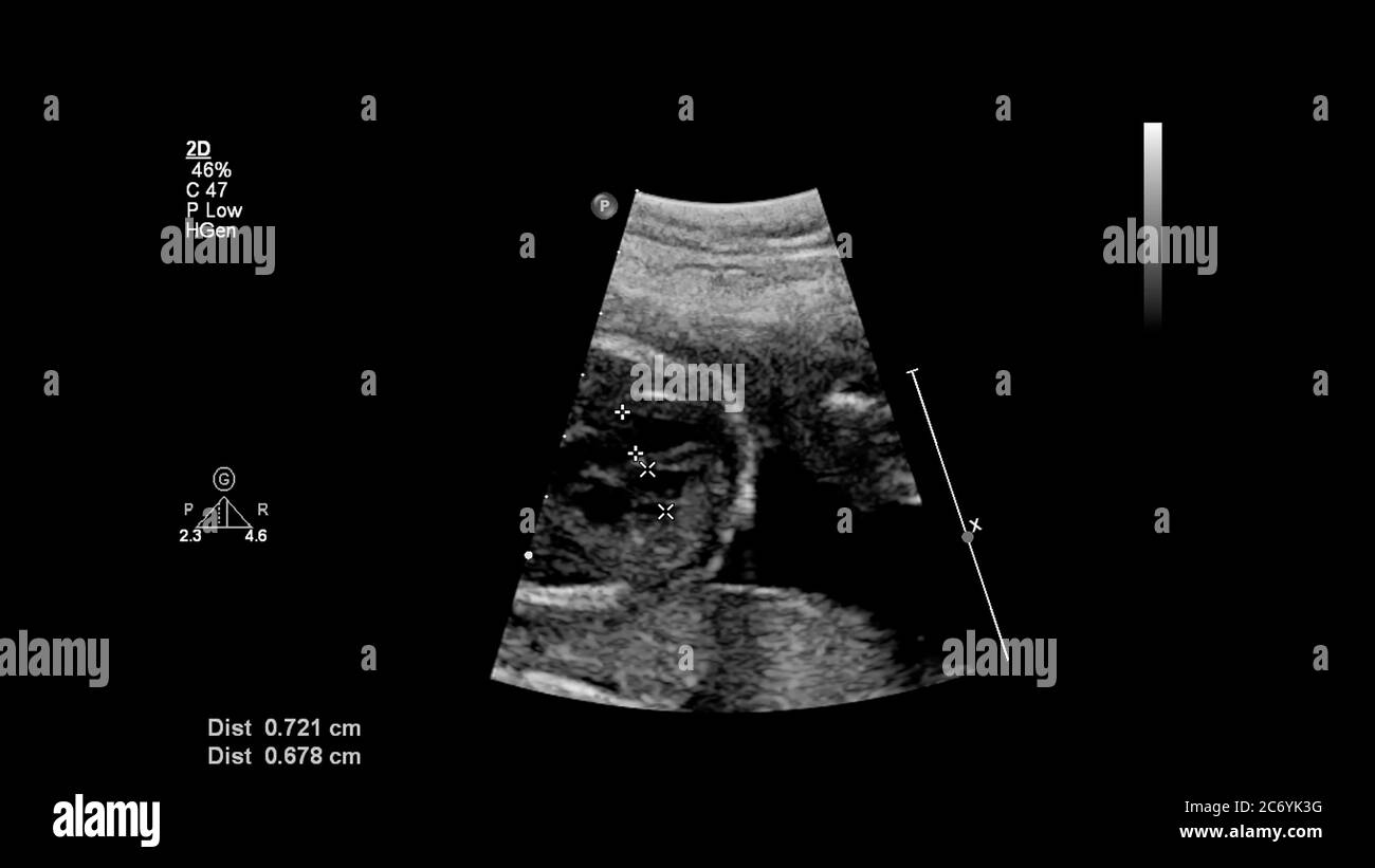 Ultrasound screen with fetal echocardiography Stock Photo - Alamy