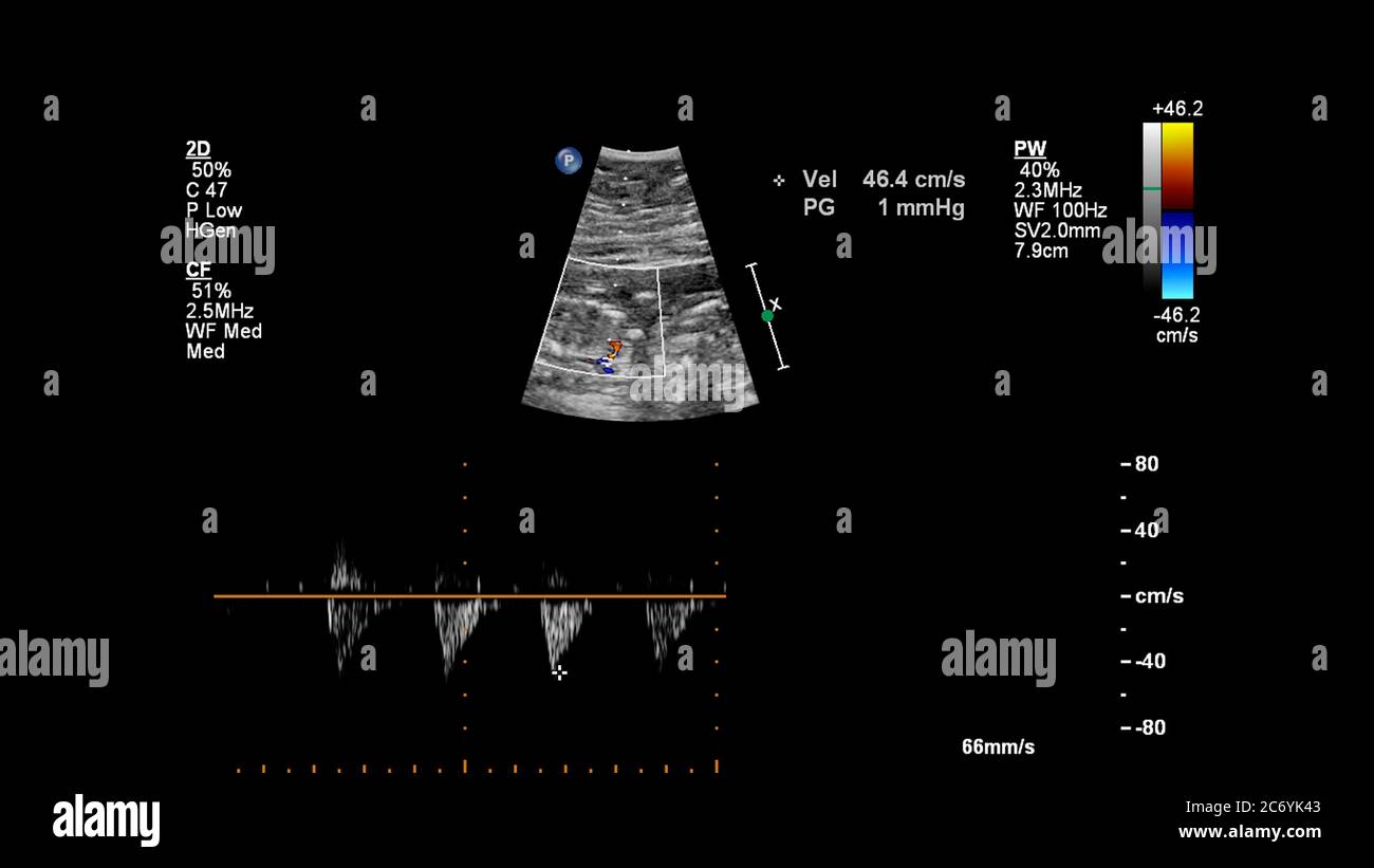 Ultrasound screen with fetal echocardiography Stock Photo - Alamy