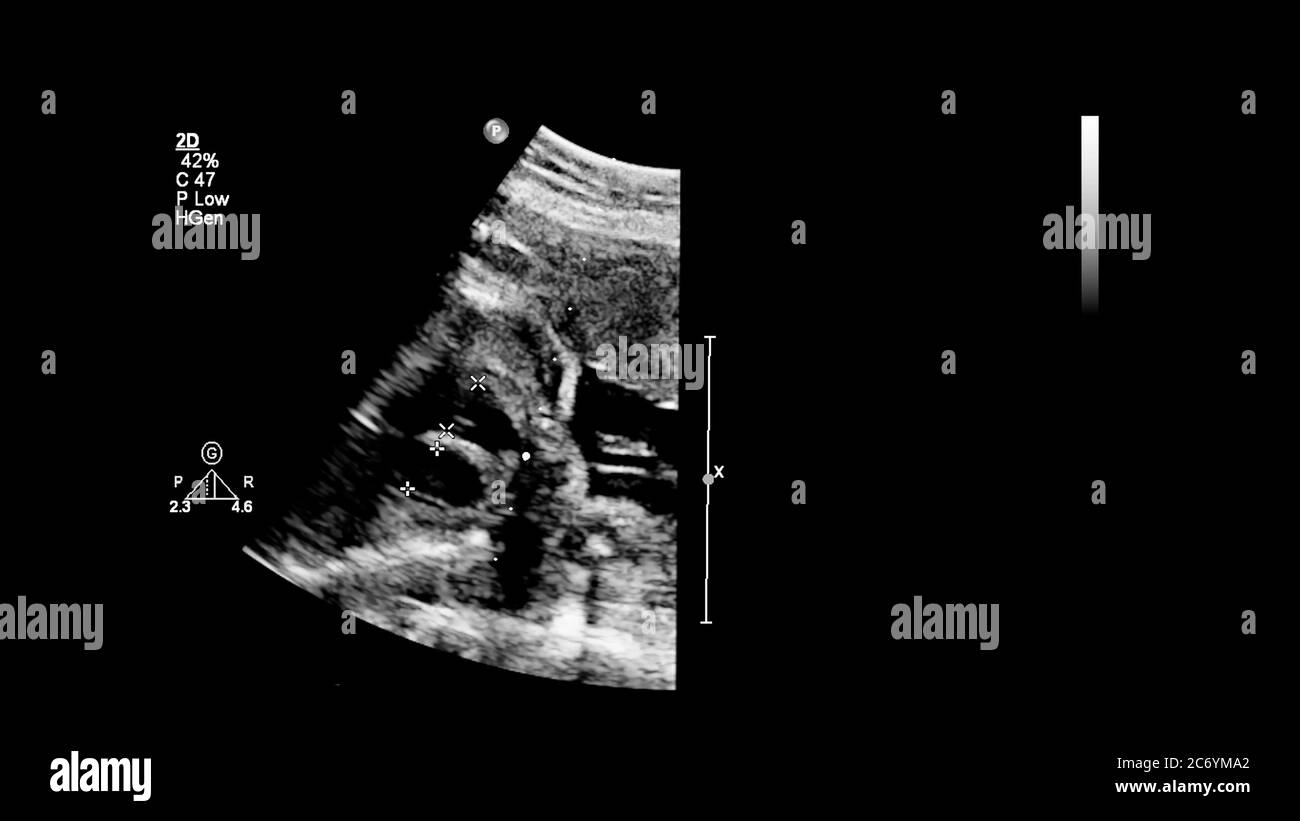 Ultrasound screen with fetal echocardiography Stock Photo - Alamy