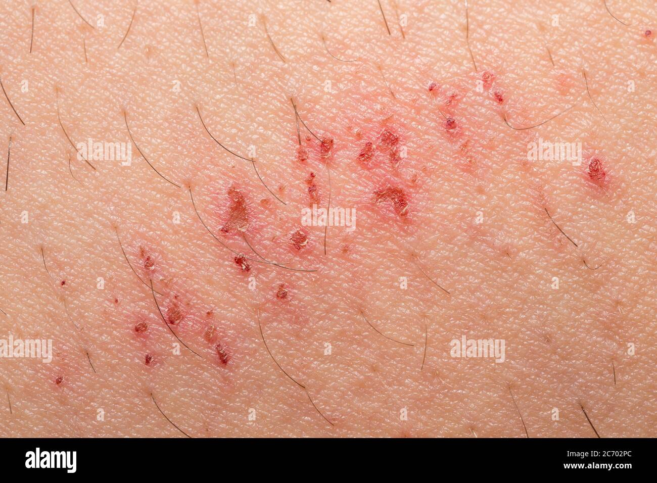 Caucasian skin scratch closeup hair macro scab white hi-res stock ...