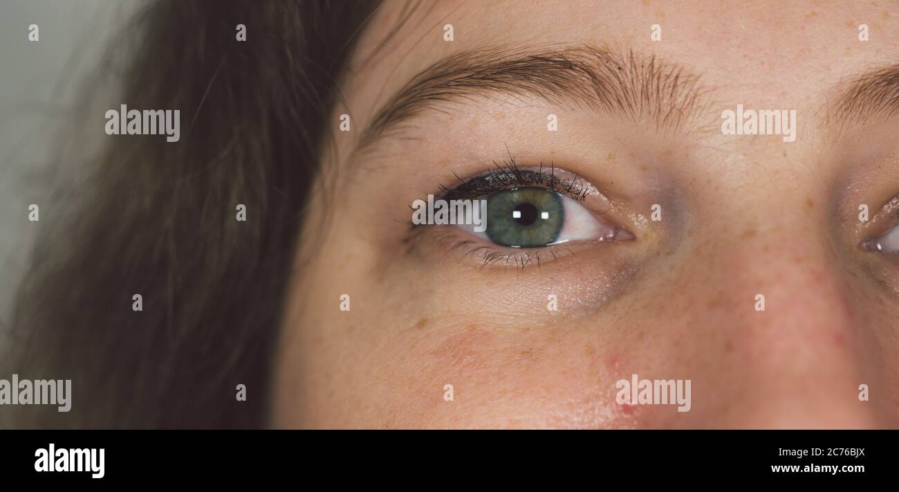 Woman with under eye bag. Puffy eye of girl showing eyes bags. Woman's ...