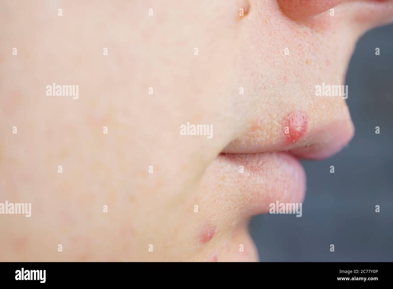 Pustules acne hi-res stock photography and images - Alamy