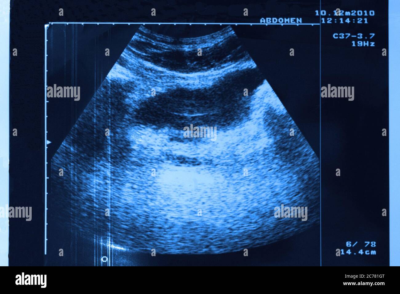 photo of ultrasound of stomach in blue tone Stock Photo - Alamy