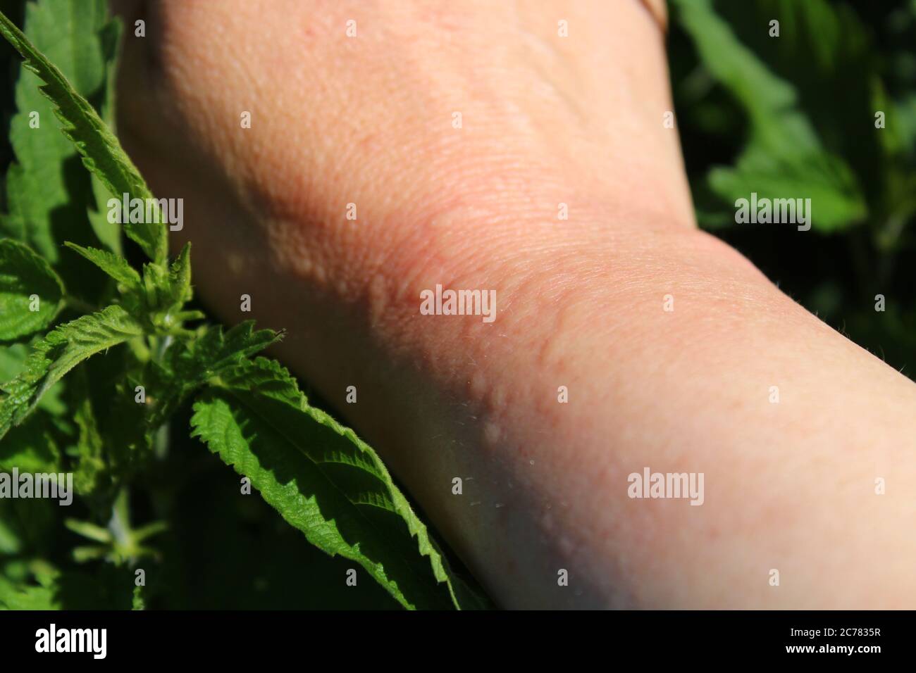 Nettle poison hi-res stock photography and images - Alamy