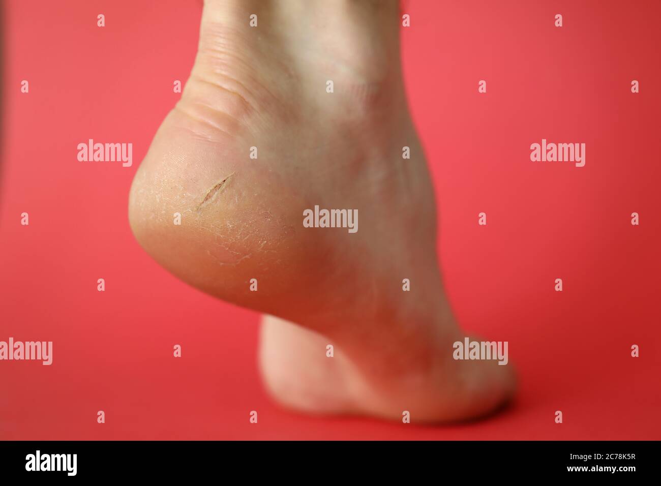 Dermatology problem hi-res stock photography and images - Alamy