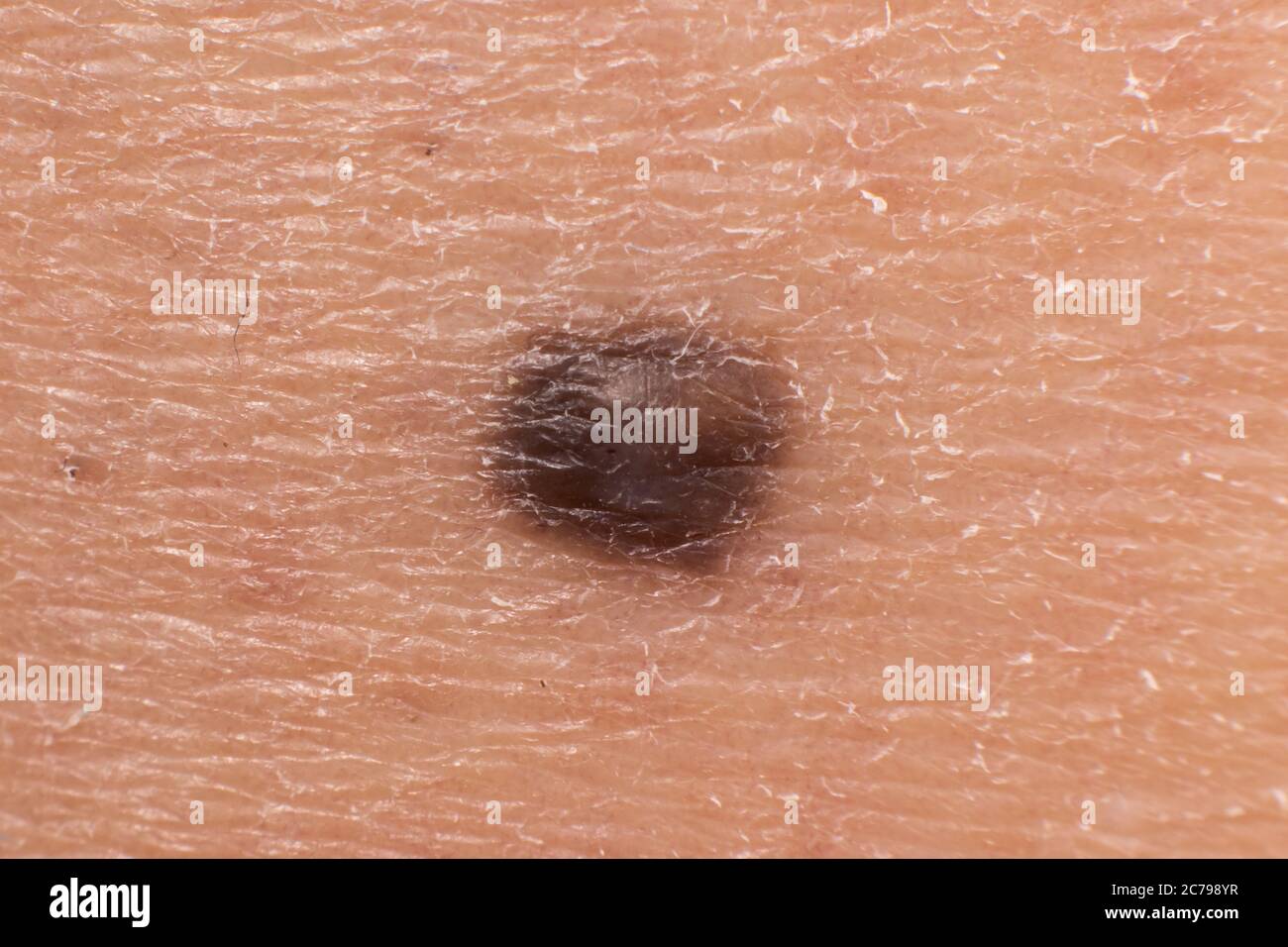 Mole birthmark nevus macro photo on human skin. Close up Stock Photo ...
