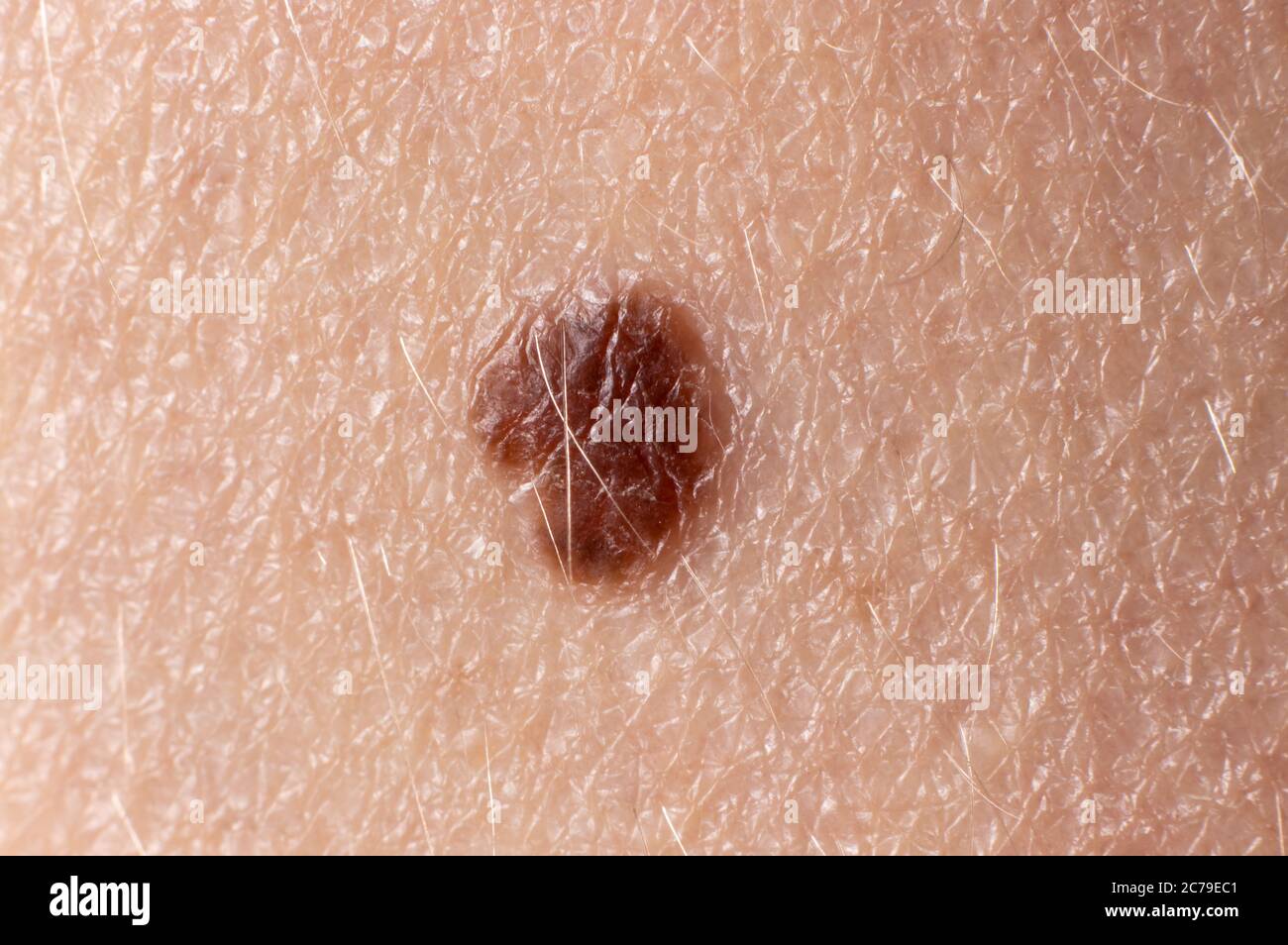 Benign Nevus