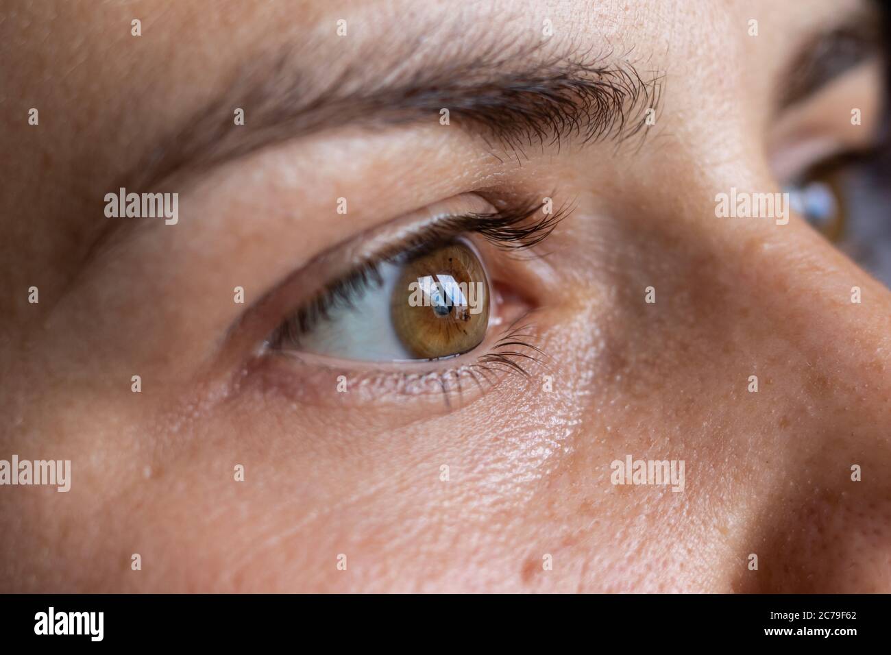 Keratoconus of both eyes, 2nd and 4th degree. Contortion of the cornea ...