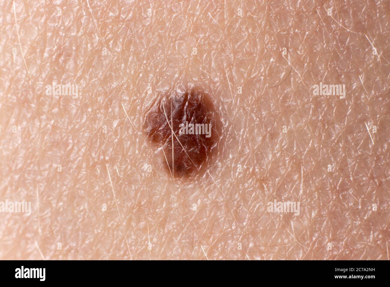 Common Skin Mole