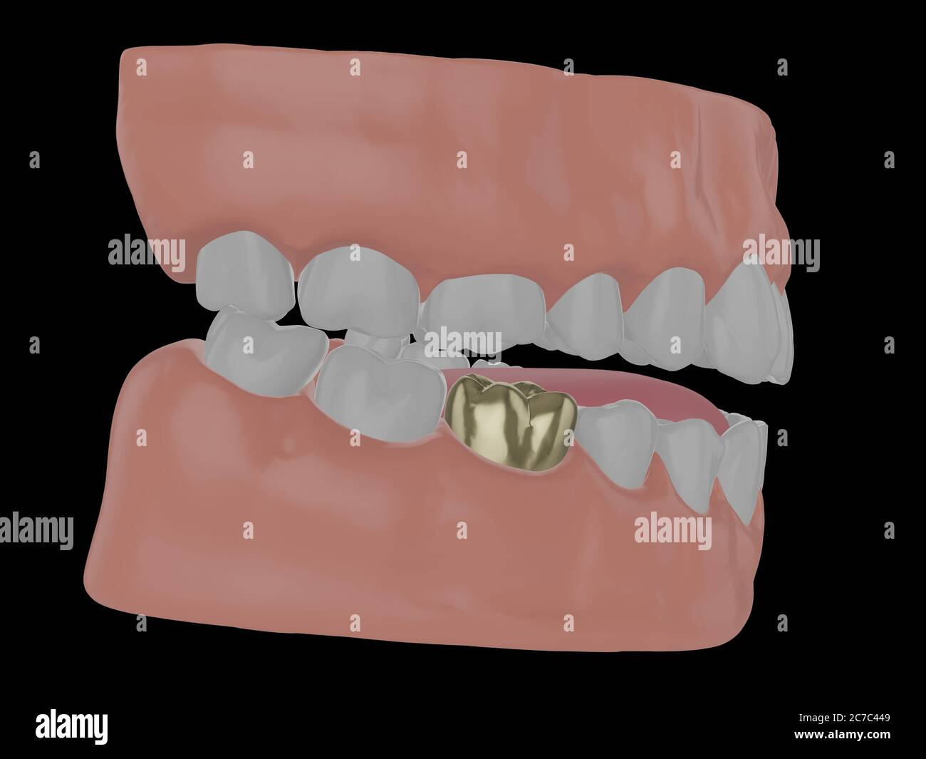 human jaw with gold tooth, golden crown of a molar, 3d render Stock ...