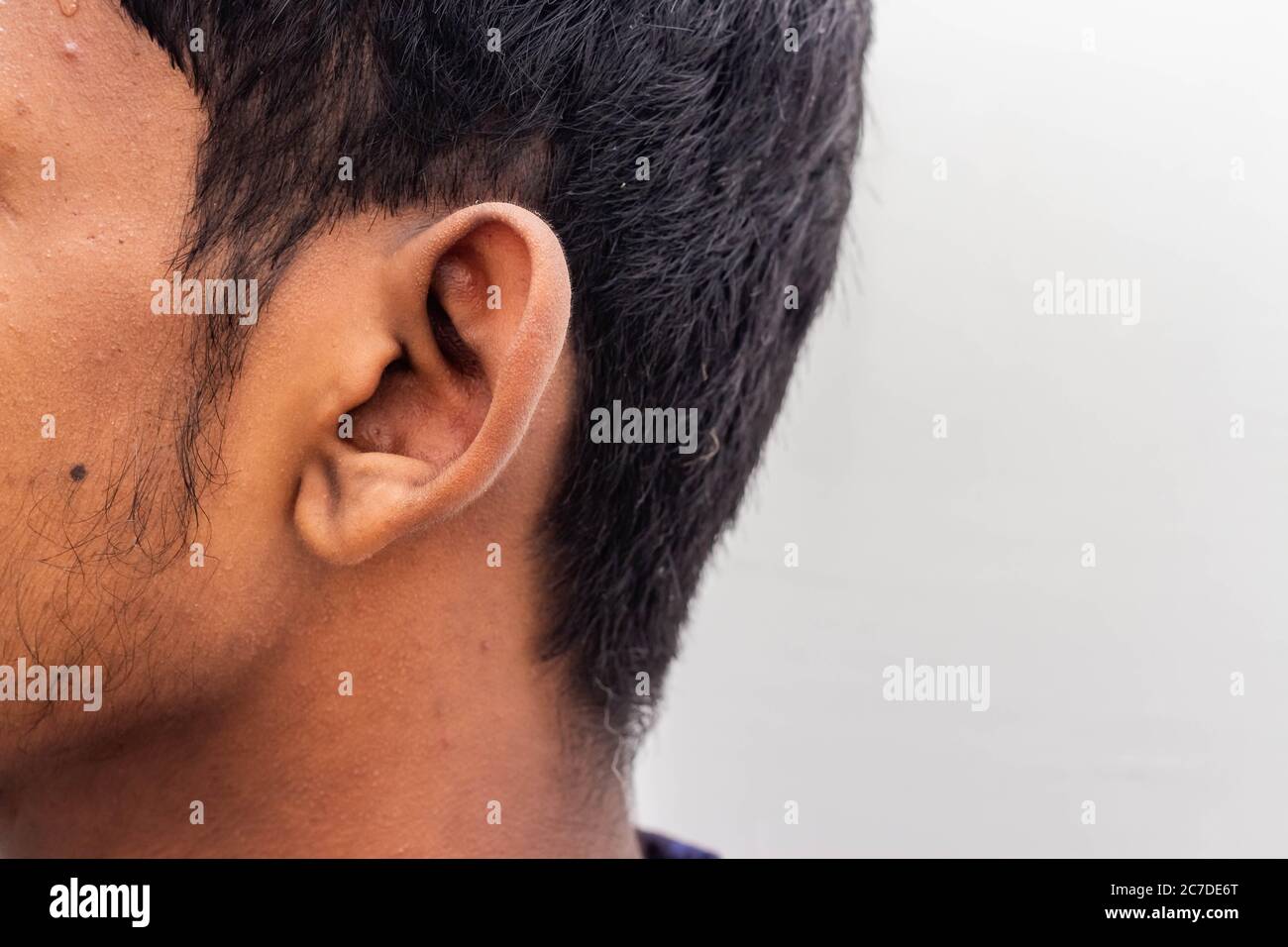 Otitis externa hi-res stock photography and images - Alamy
