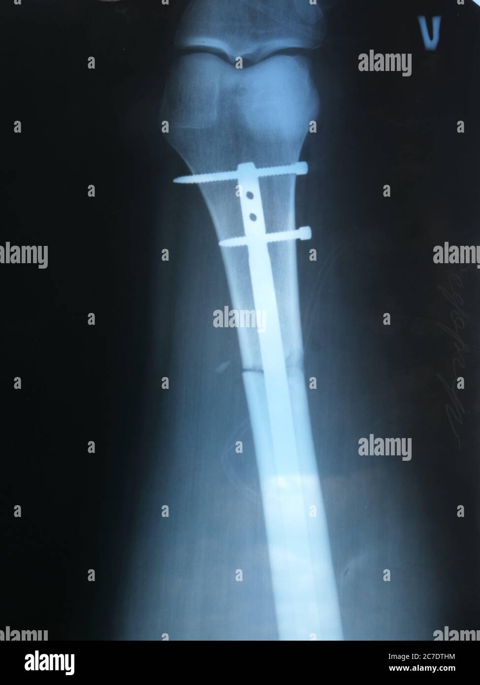 This stock photo shows the X-ray of a leg in the hospital after surgery ...