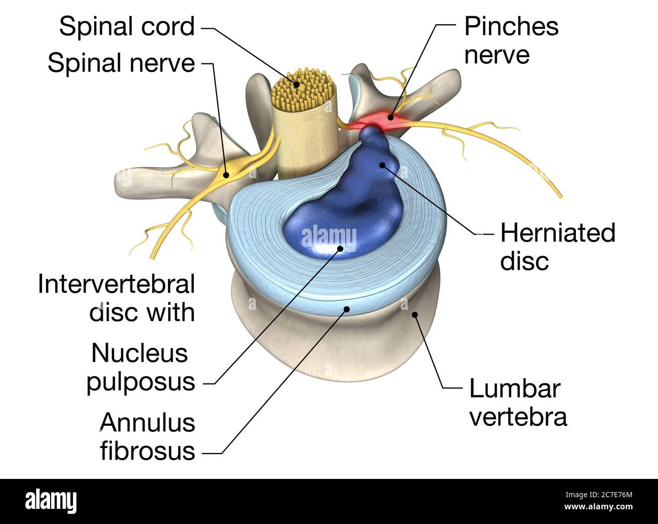 Herniated disc hi-res stock photography and images - Alamy