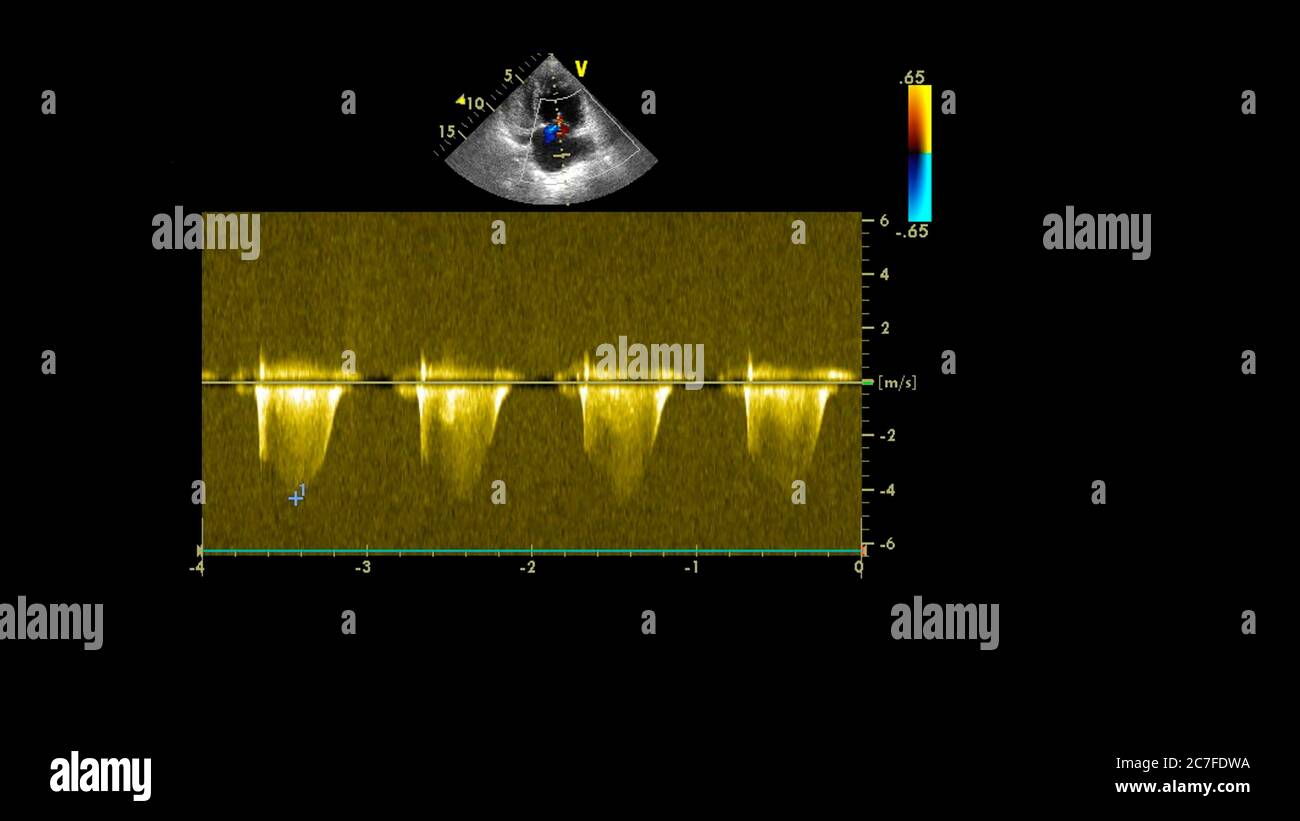 Image of the heart during transesophageal ultrasound with Doppler mode ...