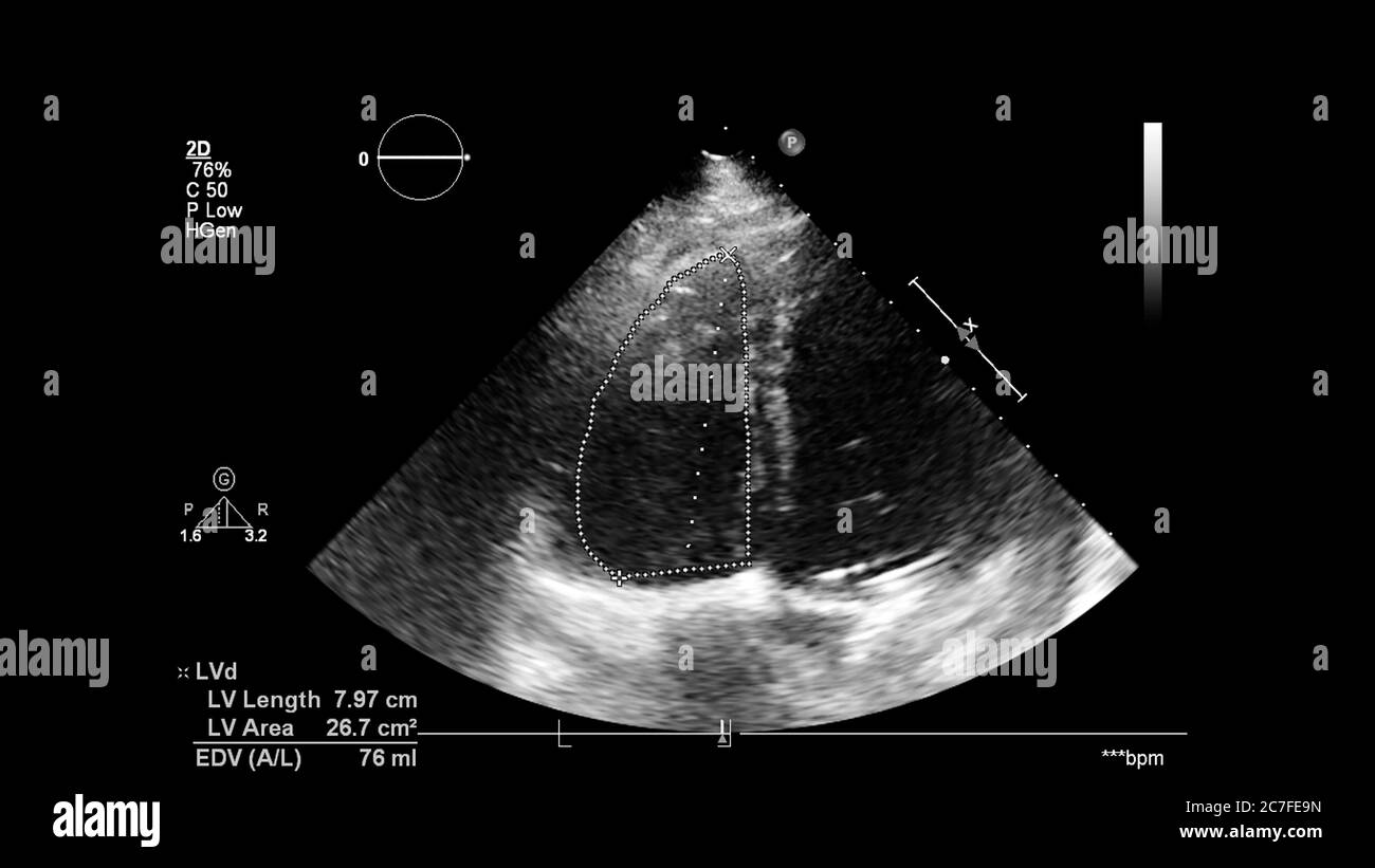 Image of the heart in gray-scale mode during transesophageal ultrasound ...