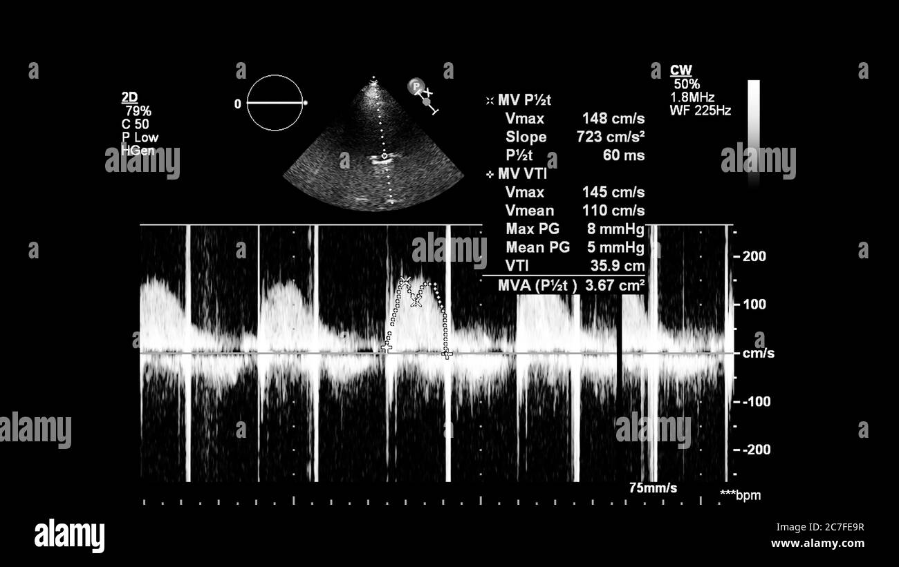 Image of the heart in gray-scale mode during transesophageal ultrasound ...