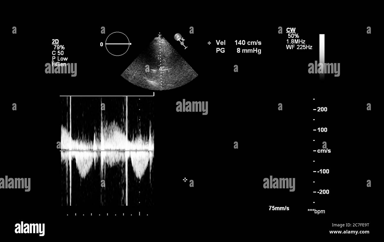 Image of the heart in gray-scale mode during transesophageal ultrasound ...