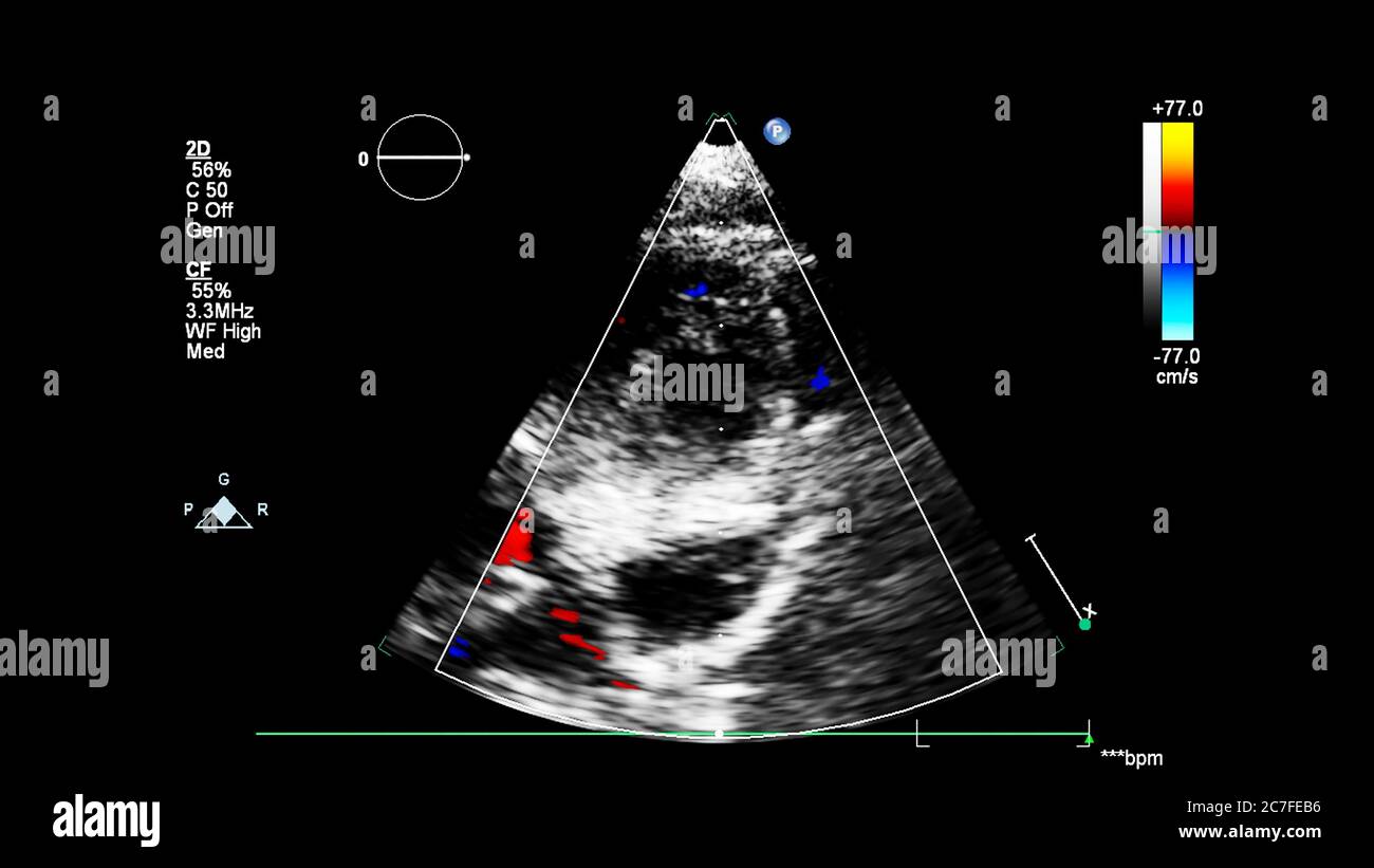 Image of the heart during transesophageal ultrasound with Doppler mode ...