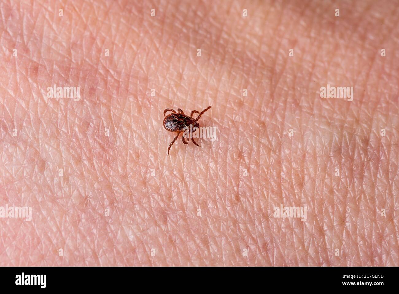 Tick on human skin. Closeup of a parasite, arachnid walking on the ...