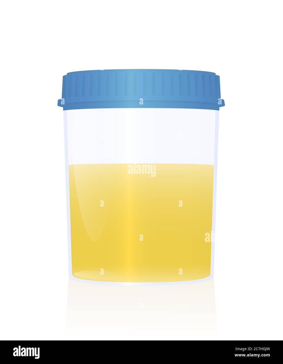 Urine sample in a specimen cup with blue cap for urological analysis ...