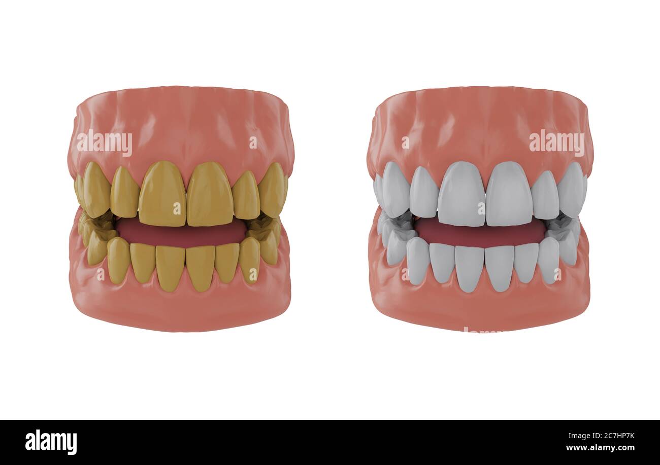 Jaw with yellow teeth, jaw with whitened teeth, Before and after ...