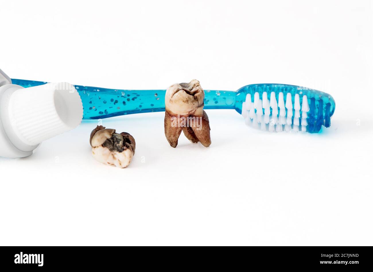 Extracted molar teeth with caries decay and filling with tooth paste ...