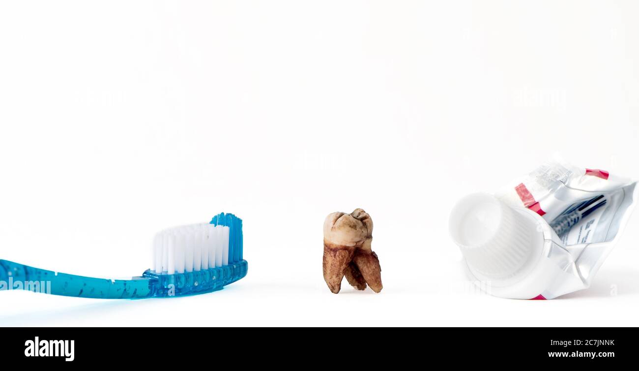 single extracted molar tooth with caries decay and filling with tooth ...