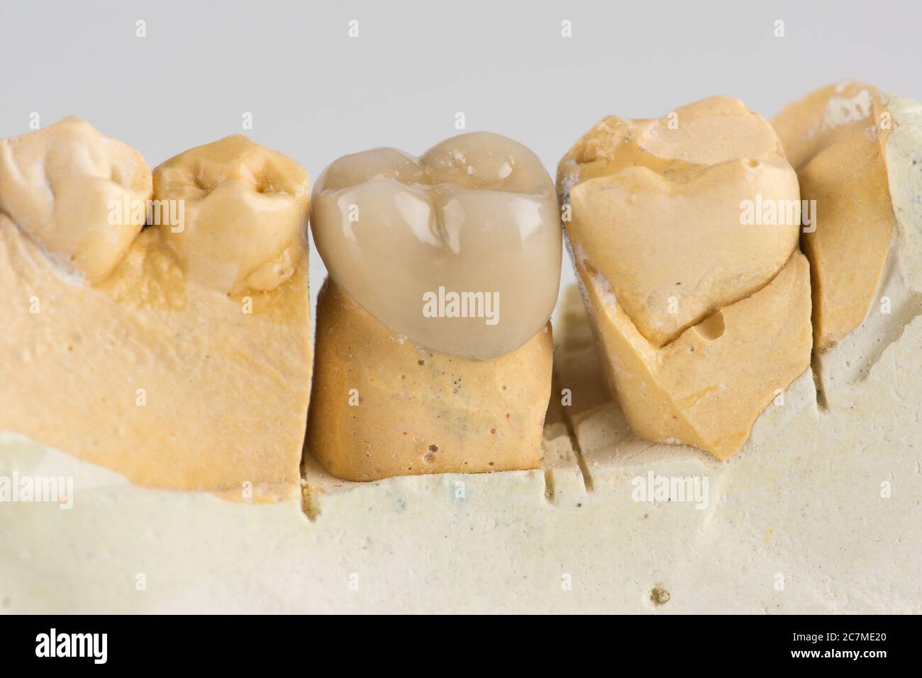 metal ceramic dental crown photographed close-up on a white background ...