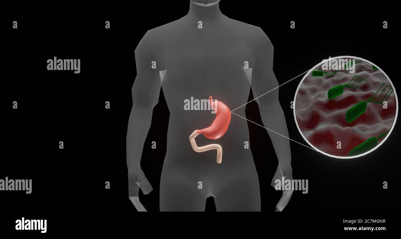 Helicobacter pylori infection hi-res stock photography and images - Alamy