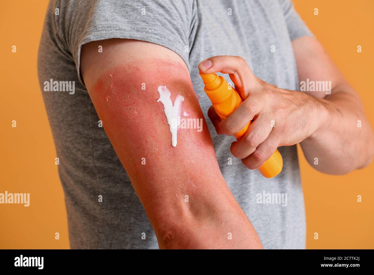 Dermatitis solar hi-res stock photography and images - Alamy