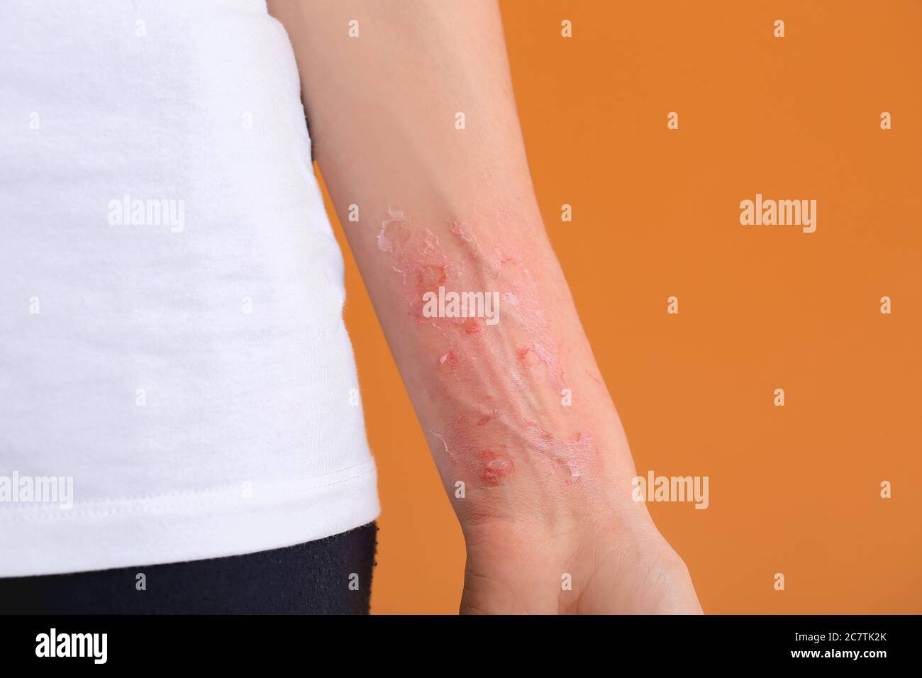 Dermatitis solar hi-res stock photography and images - Alamy