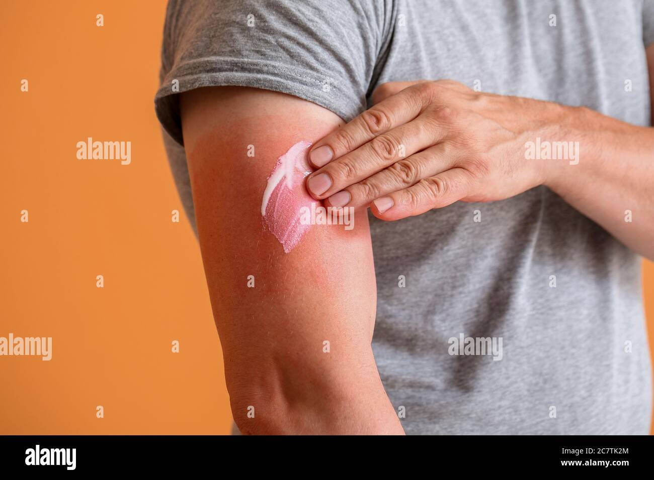 Dermatitis solar hi-res stock photography and images - Alamy