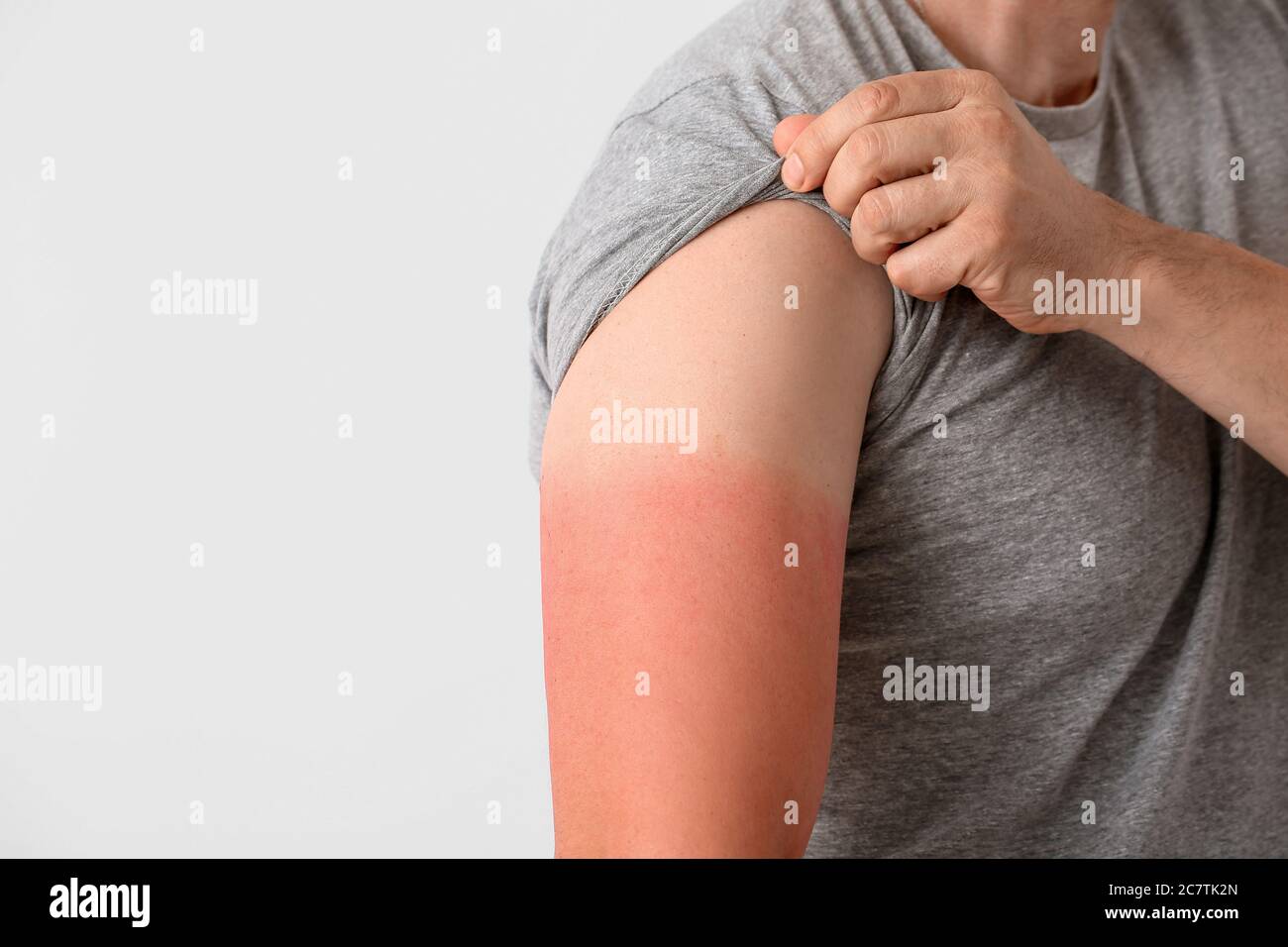 Light Sunburn