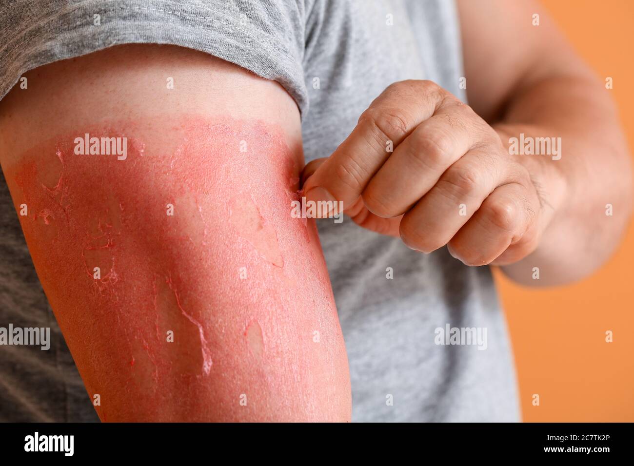 Dermatitis solar hi-res stock photography and images - Alamy