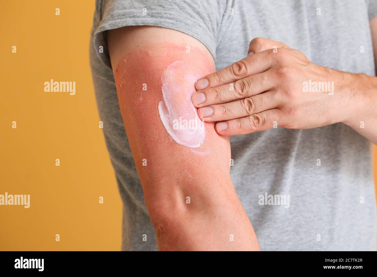 Dermatitis solar hi-res stock photography and images - Alamy