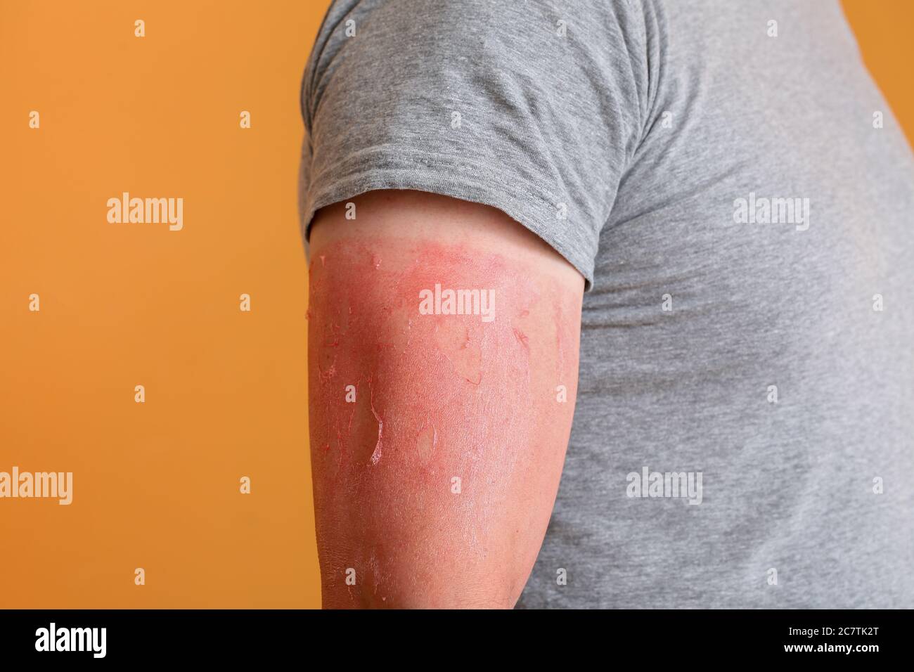 Dermatitis solar hi-res stock photography and images - Alamy