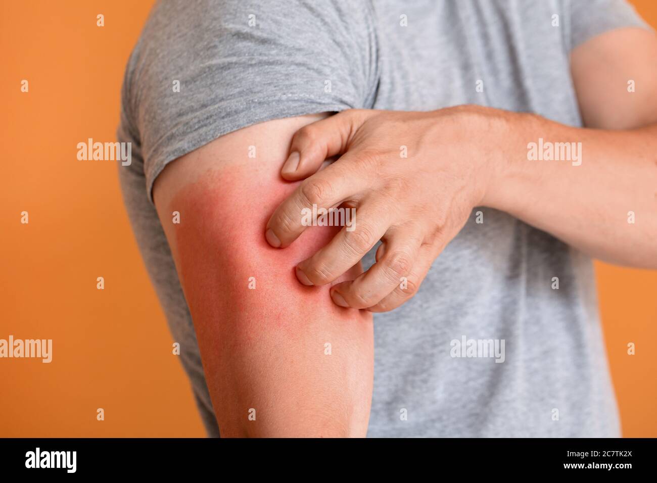 Dermatitis solar hi-res stock photography and images - Alamy