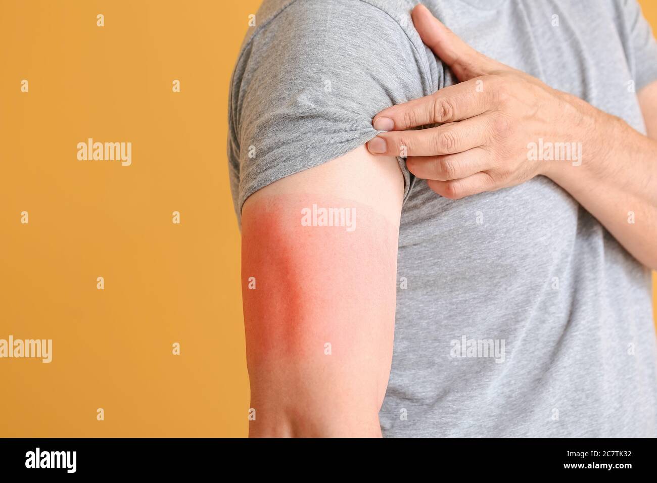 Man with red sunburned skin against color background, closeup Stock ...