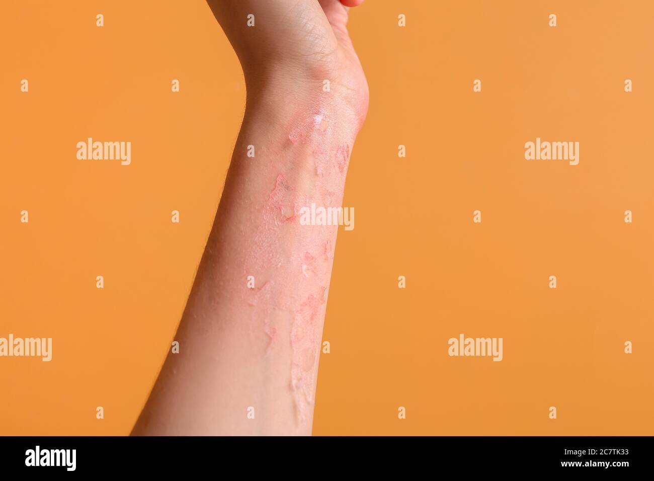 Dermatitis solar hi-res stock photography and images - Alamy