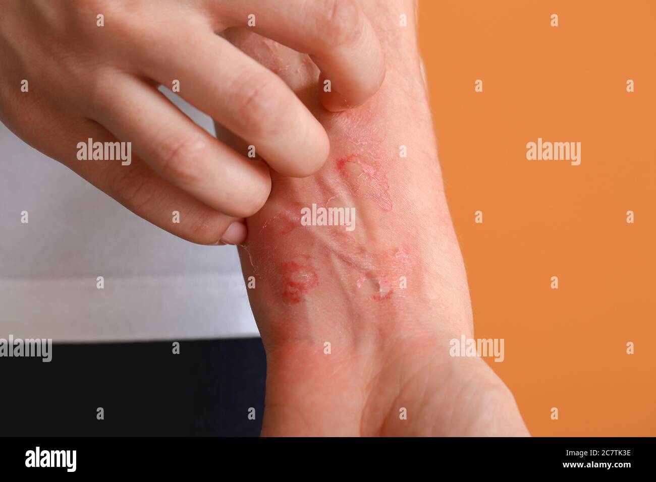 Dermatitis solar hi-res stock photography and images - Alamy