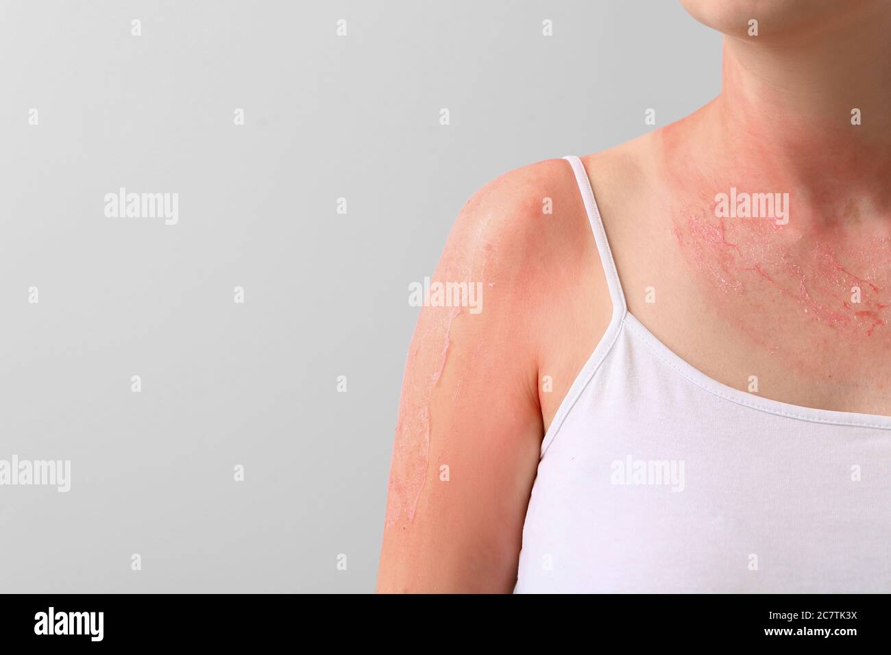 Dermatitis solar hi-res stock photography and images - Alamy