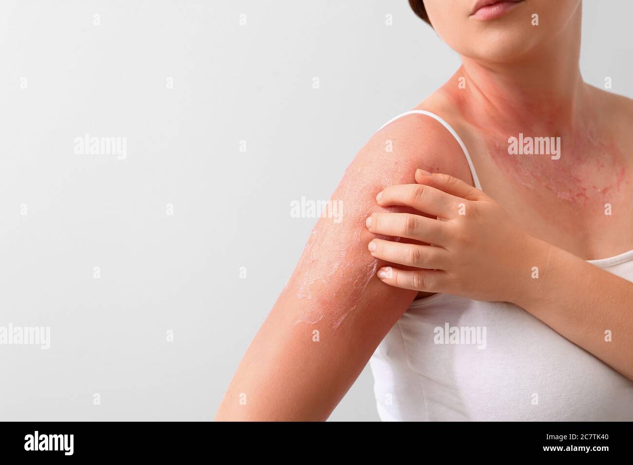 Woman with red sunburned skin against light background Stock Photo - Alamy